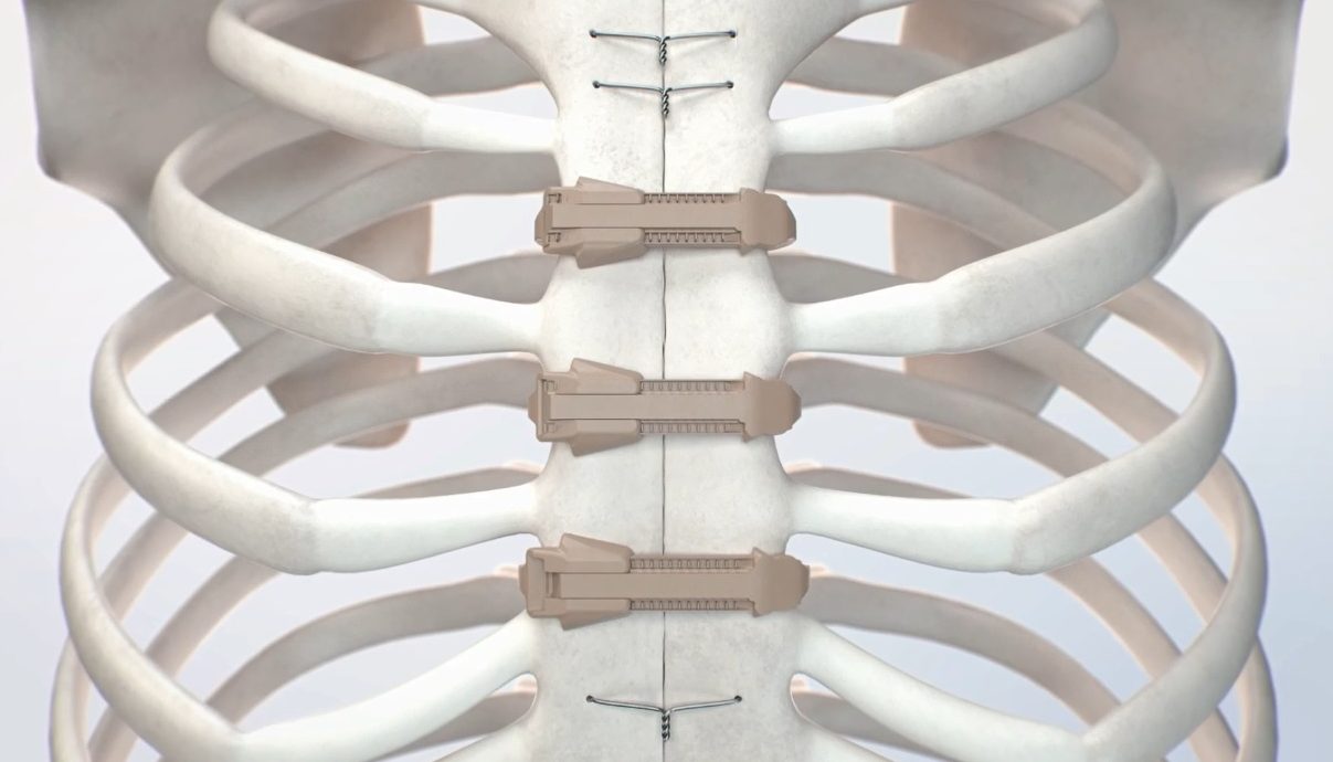 NEOS Surgery - cardiothoracic