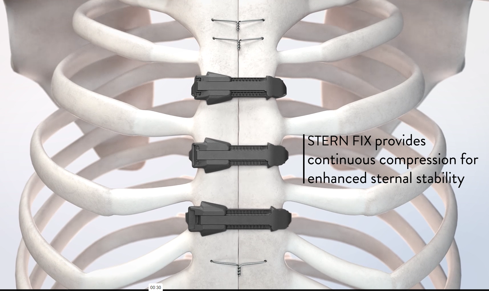 NEOS Surgery - STERN FIX – Sternal Stabilization system